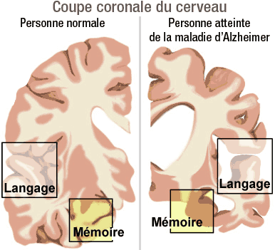 Plan Alzheimer et maladies apparentées 2008-2012: I. La maladie d’Alzheimer